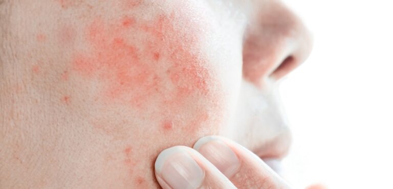 La dermatite allergica da contatto - Santagostino Garbatella