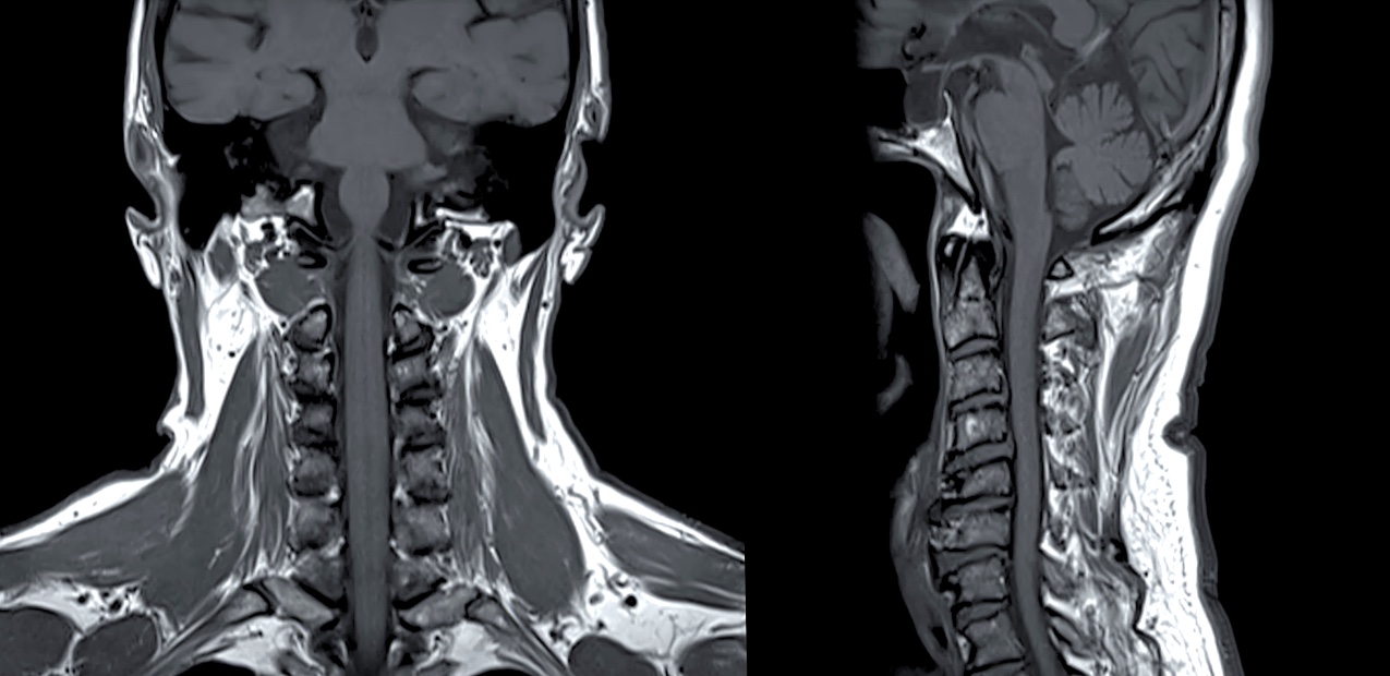 Risonanza magnetica cervicale: quando è necessaria e cosa rileva ...